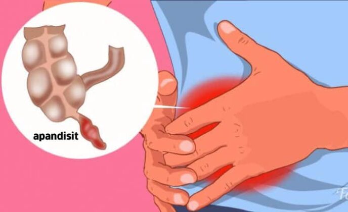 Apandisit neden patlar? Belirtileri nelerdir? Ameliyatı ve tedavisi