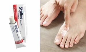 Stafine krem ayak mantarı ve dolama için kullanılır mı? - Sağlık Haberleri