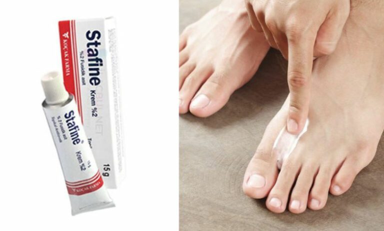 Stafine krem ayak mantarı ve dolama için kullanılır mı? - Sağlık Haberleri